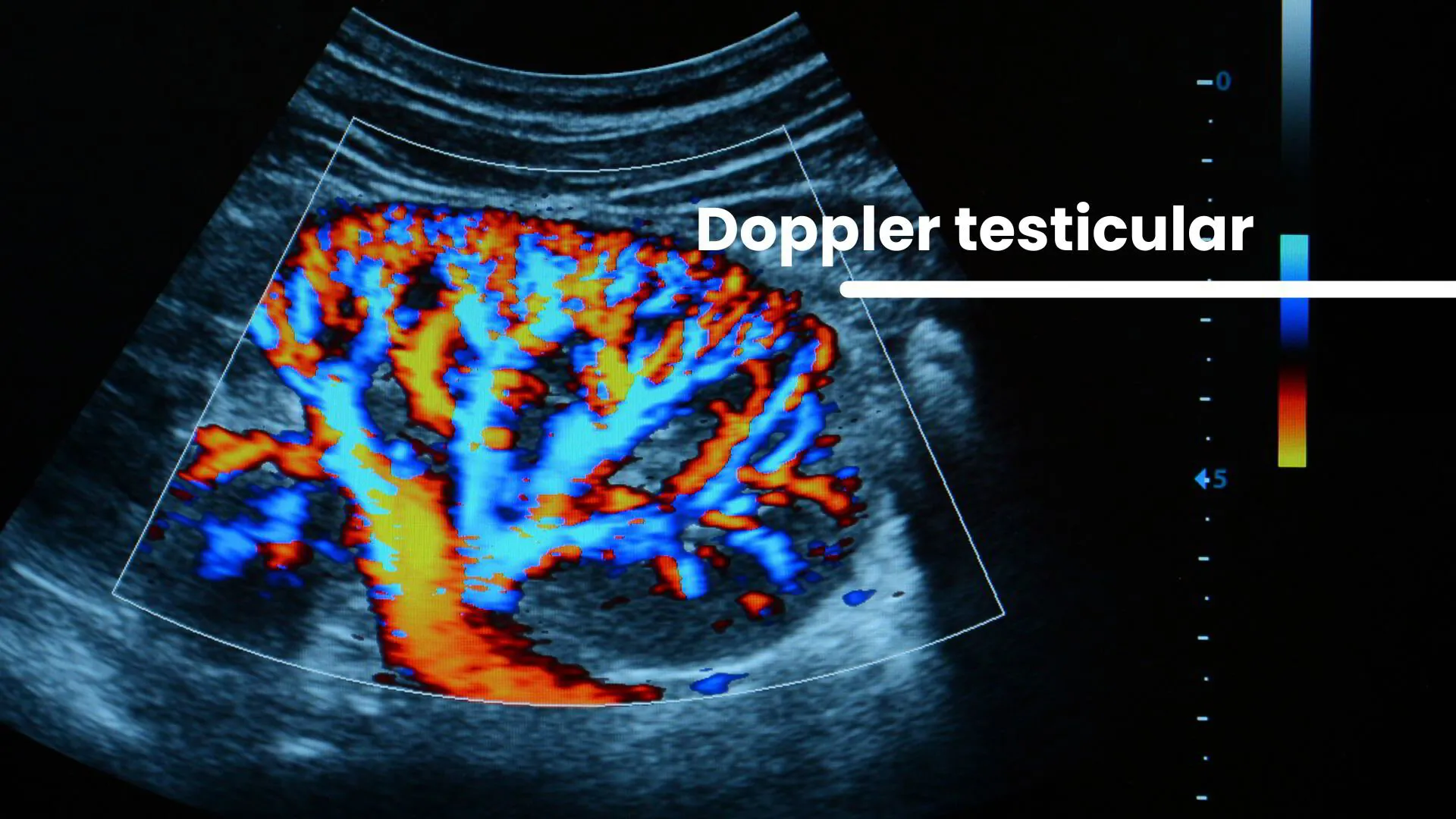 ¿Cómo ayuda el doppler testicular en la detección de varicocele?