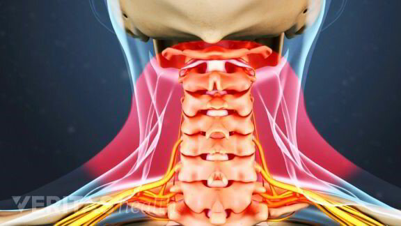Discogenic Wry Neck Recovery _ Wry Neck Symptoms And Treatment – TZBU