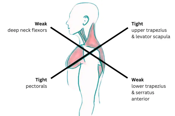 What Are The Signs Of A Tech Neck?