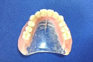 Full Dentures Designed and Fitted