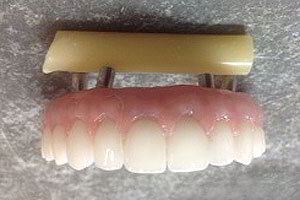 Implant Retained Dentures | Southside Denture Clinic
