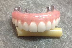 Implant Retained Dentures | Southside Denture Clinic