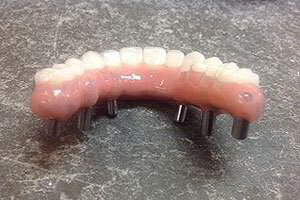 Implant Retained Dentures | Southside Denture Clinic