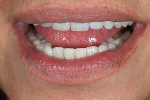 Chrome Dentures | Southside Denture Clinic