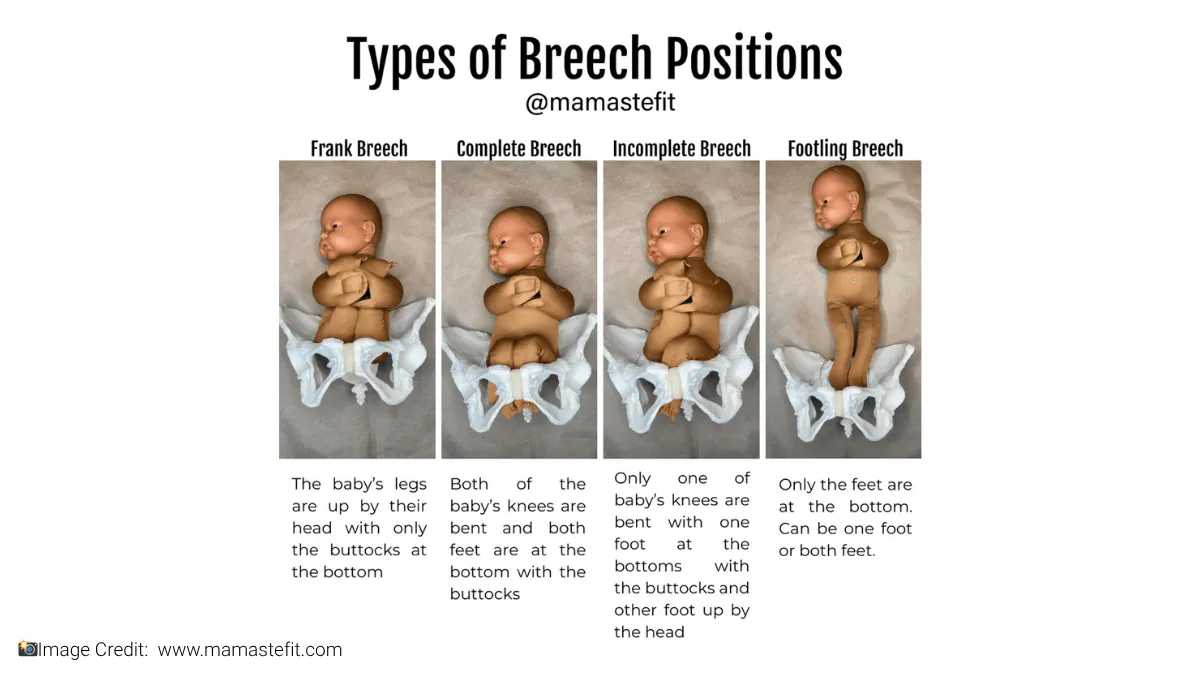 You Just Found Out Your Baby is Breech- Here is What You Can Do