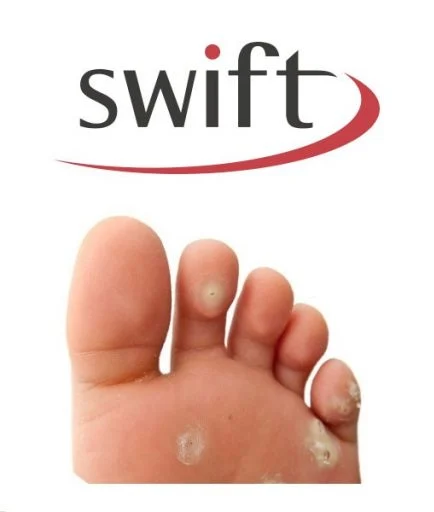 Swift Verrucae & Wart Treatment