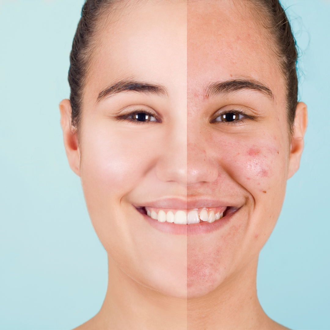 Achieve Clear Skin: The Power of Low-Level Laser Therapy for Acne Treatment