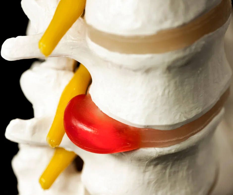 Understanding Herniated Disc!
