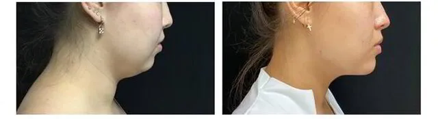 BODY CONTOURING & FAT REDUCTION