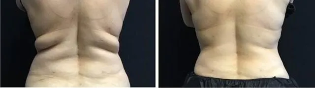 BODY CONTOURING & FAT REDUCTION