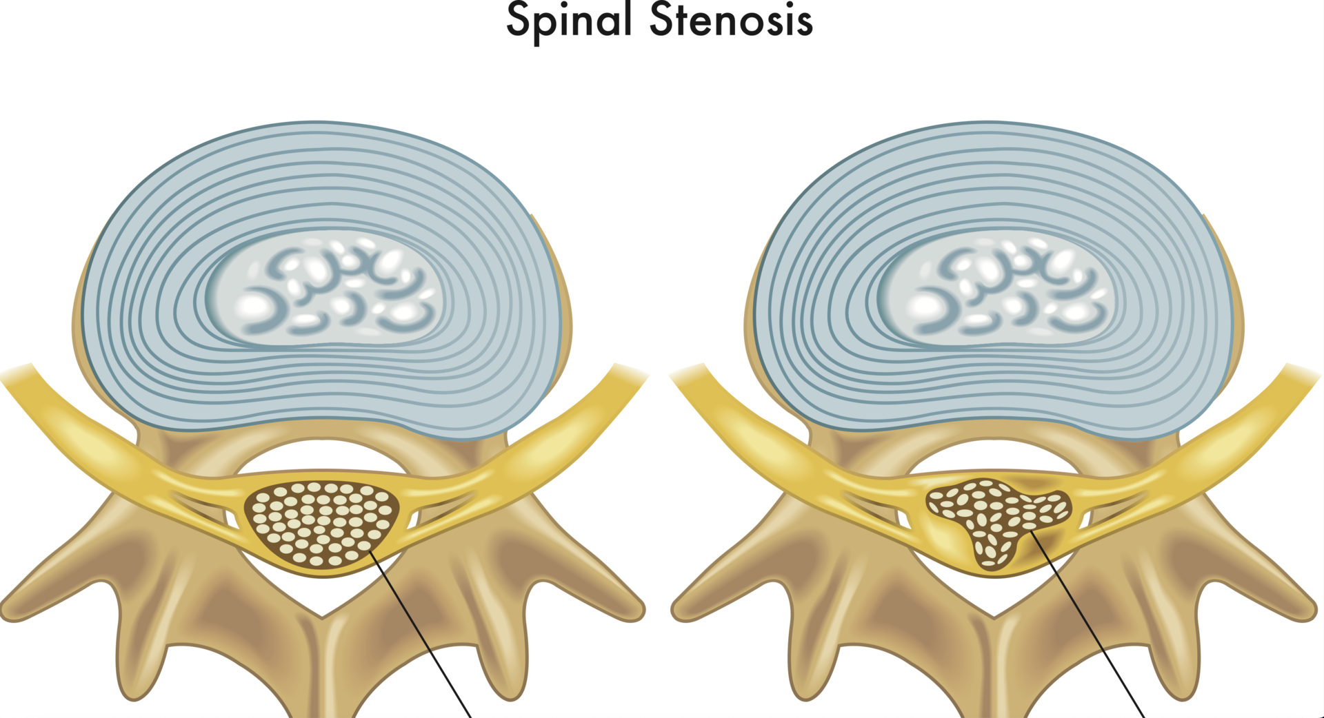 Spinal Stenosis