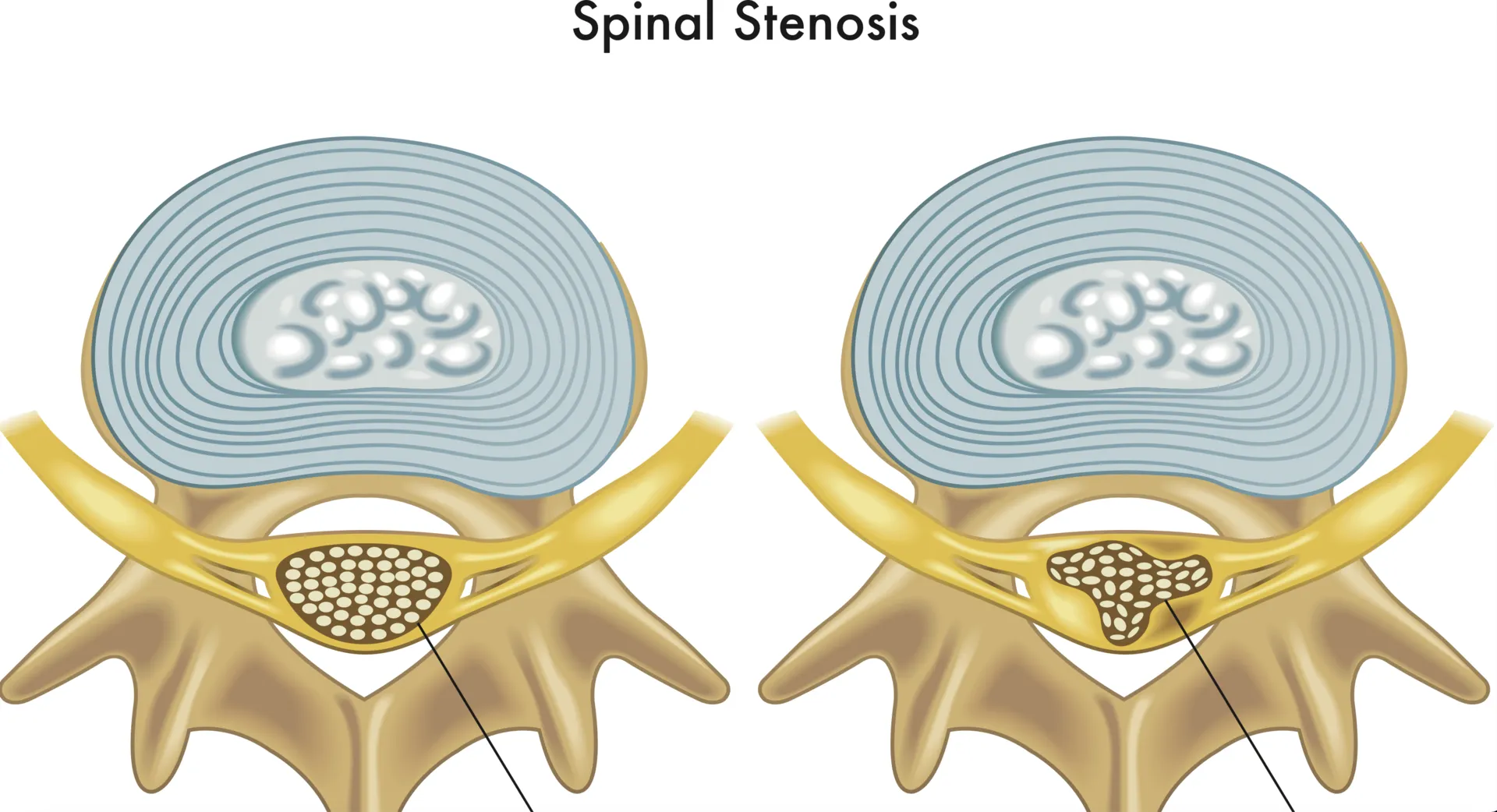 Spinal Stenosis