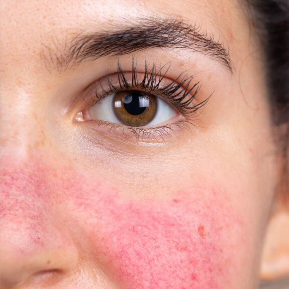 Understanding Rosacea: An Inside-Out Approach to Skin Health