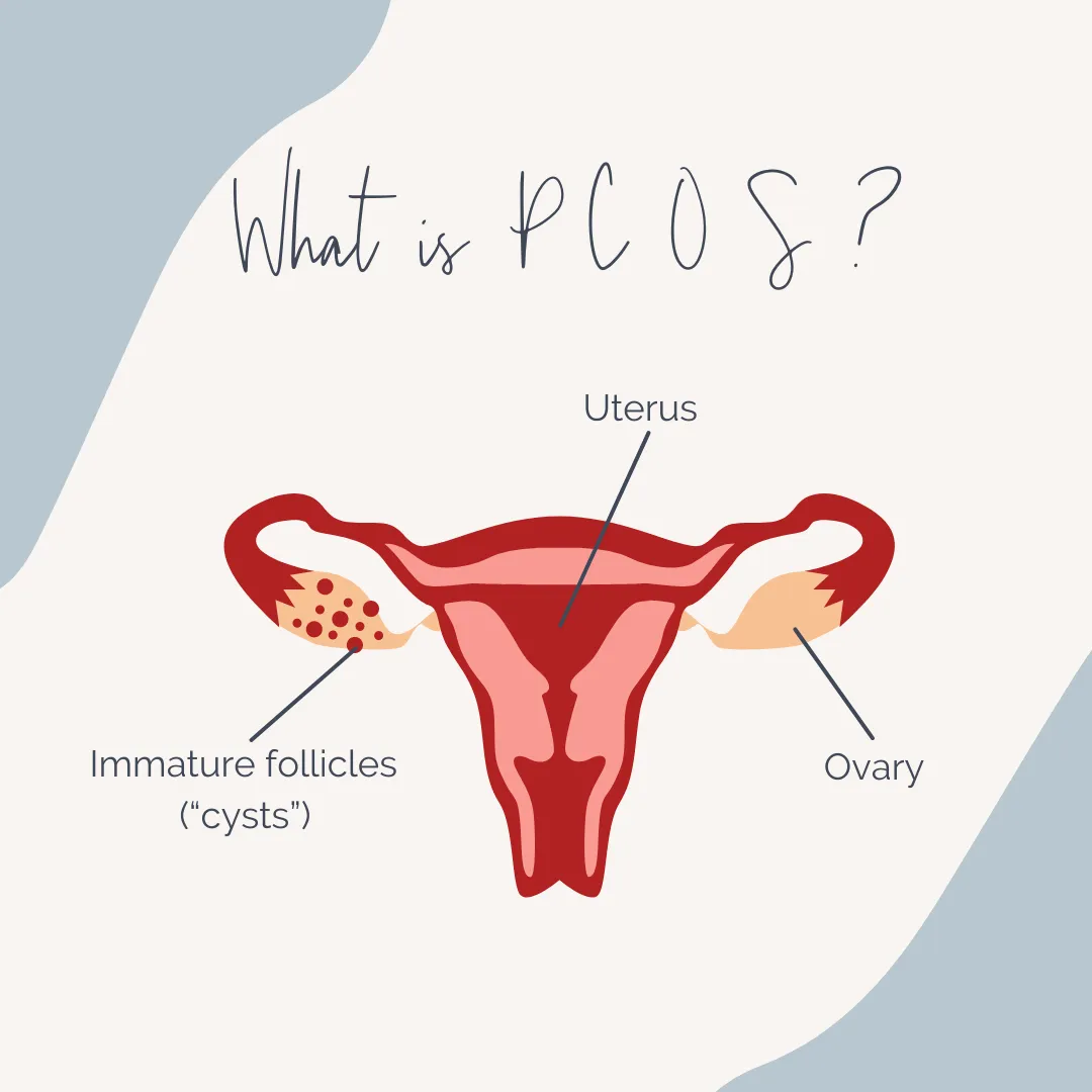 What is PCOS? Understanding the Syndrome and Its Impacts