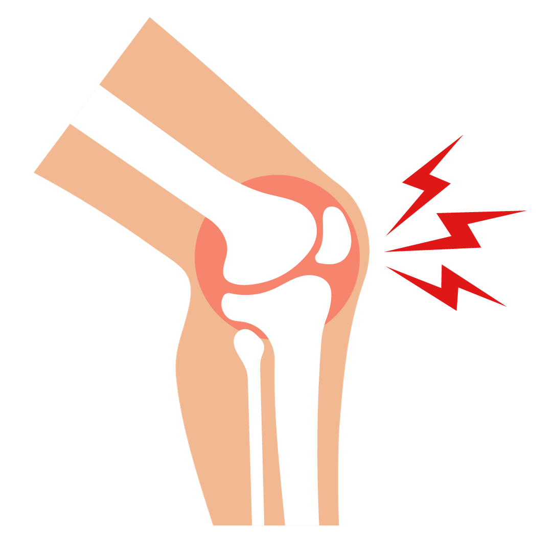 Syndrome rotulien ou fémoro-patellaire : soulagez votre genou grâce à l ...