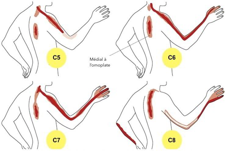 Névralgie Cervico-Brachiale (NCB) : les bienfaits de l’Ostéopathie