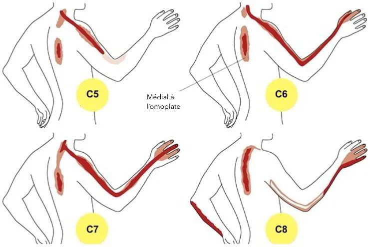 Névralgie Cervico-Brachiale (NCB) : les bienfaits de l’Ostéopathie