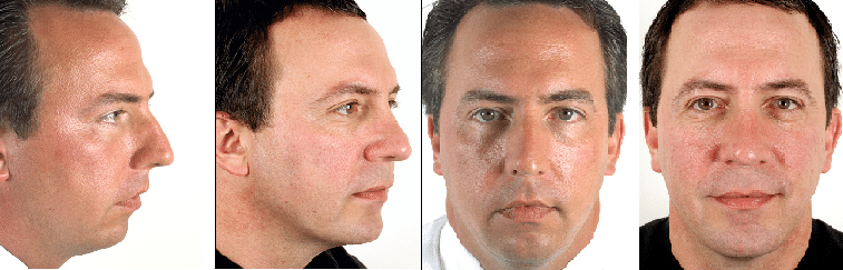 Cosmetic Chin Surgery | Facelift Specialist | Sydney Aesthetics