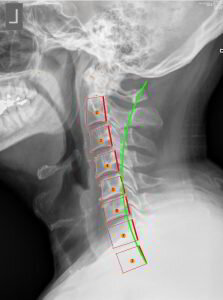 The Benefits of Universal X-Ray Attachment to Chiropractic EMR/EHR: A ...
