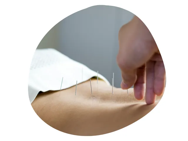 Acupuncture - Vital Physiotherapy Toronto, Ontario