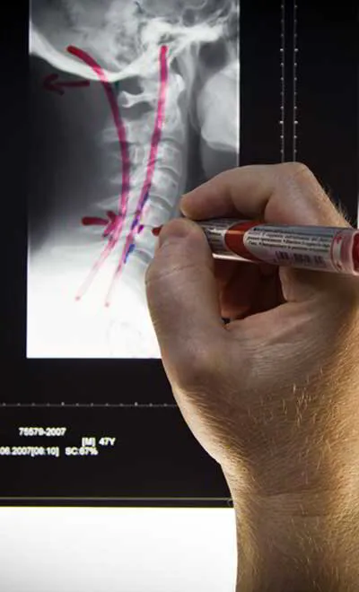 What is a Pinched Nerve | Jermyn Chiropractic Hillcrest