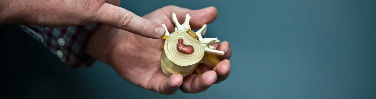 Slipped or Herniated Discs | Jermyn Chiropractic Hillcrest