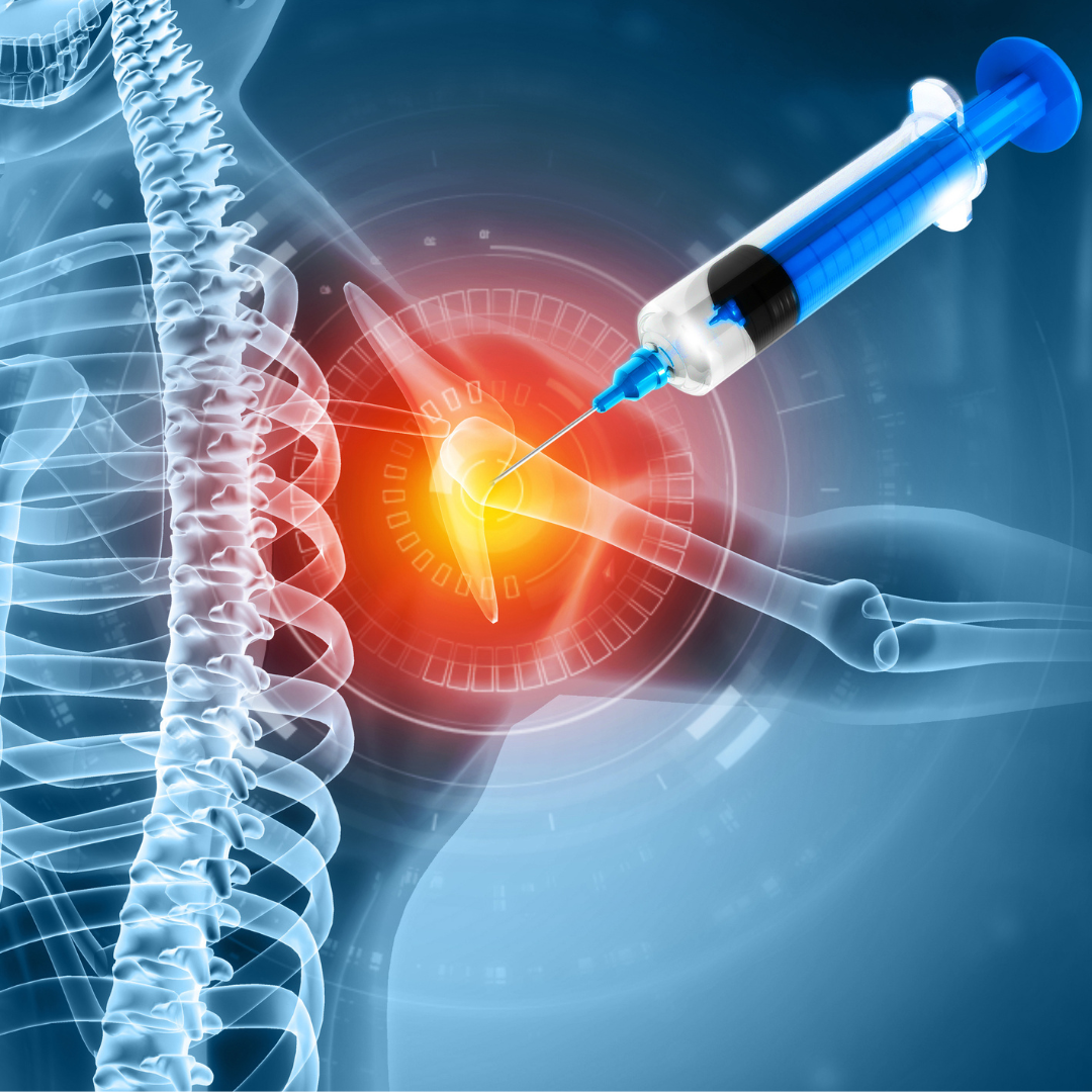 What is Prolotherapy and How Does It Relieve Joint Pain?