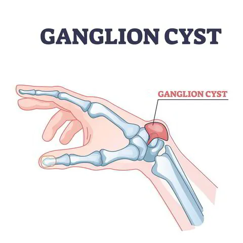 Ganglion Cyste: Symptomer, behandling og forebyggelse