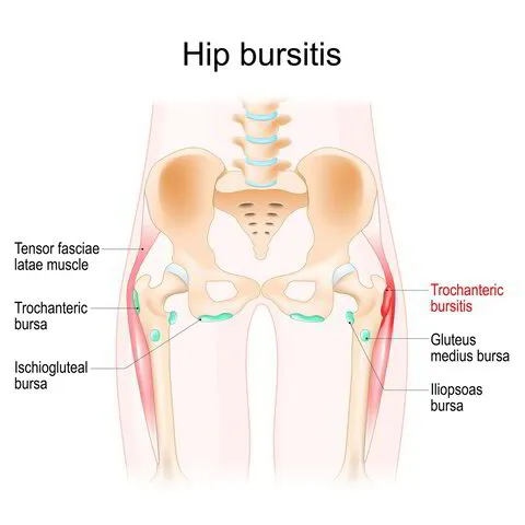 Bursitis (slimsækbetændelse) i hoften: Symptomer, behandling og ...