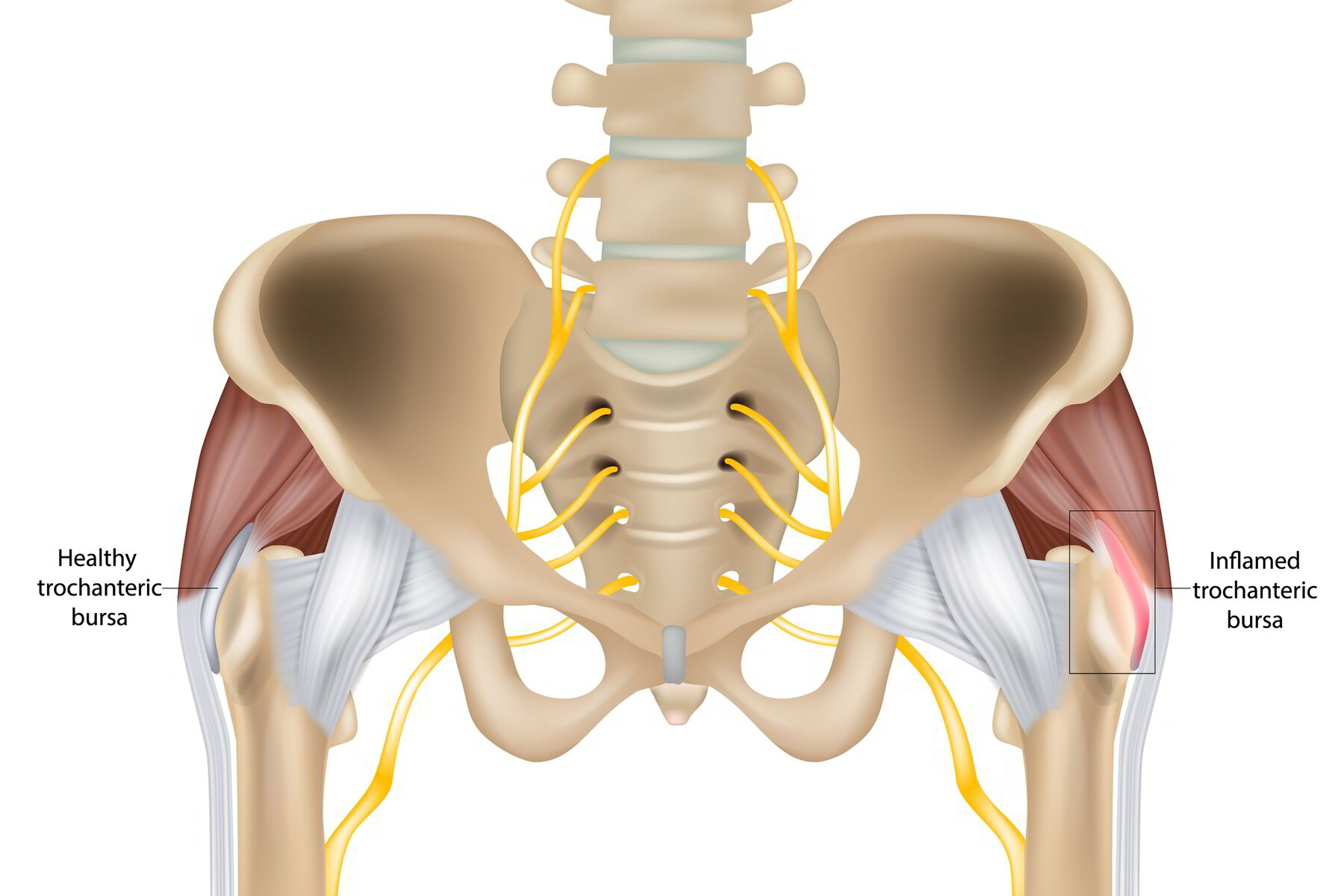 Bursitis (slimsækbetændelse) i hoften: Symptomer, behandling og ...