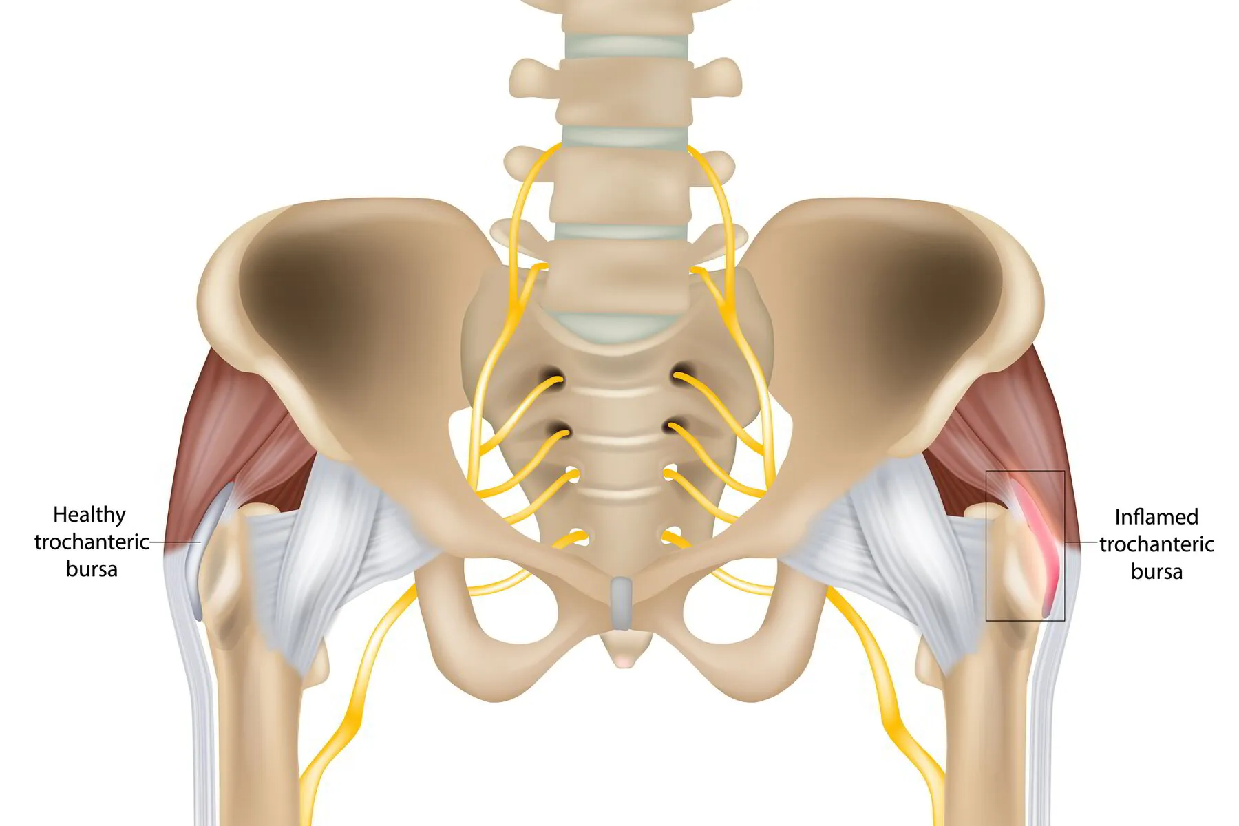 Bursitis (slimsækbetændelse) i hoften: Symptomer, behandling og ...