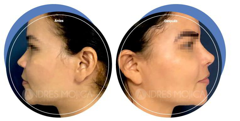 Rinoplastia