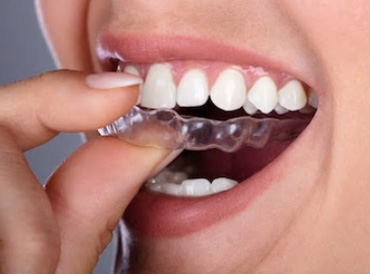 Why Choose Angel Smile Clear Aligners Treatment?