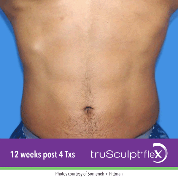 BeyondHealthyMD - Body - truSculpt Flex