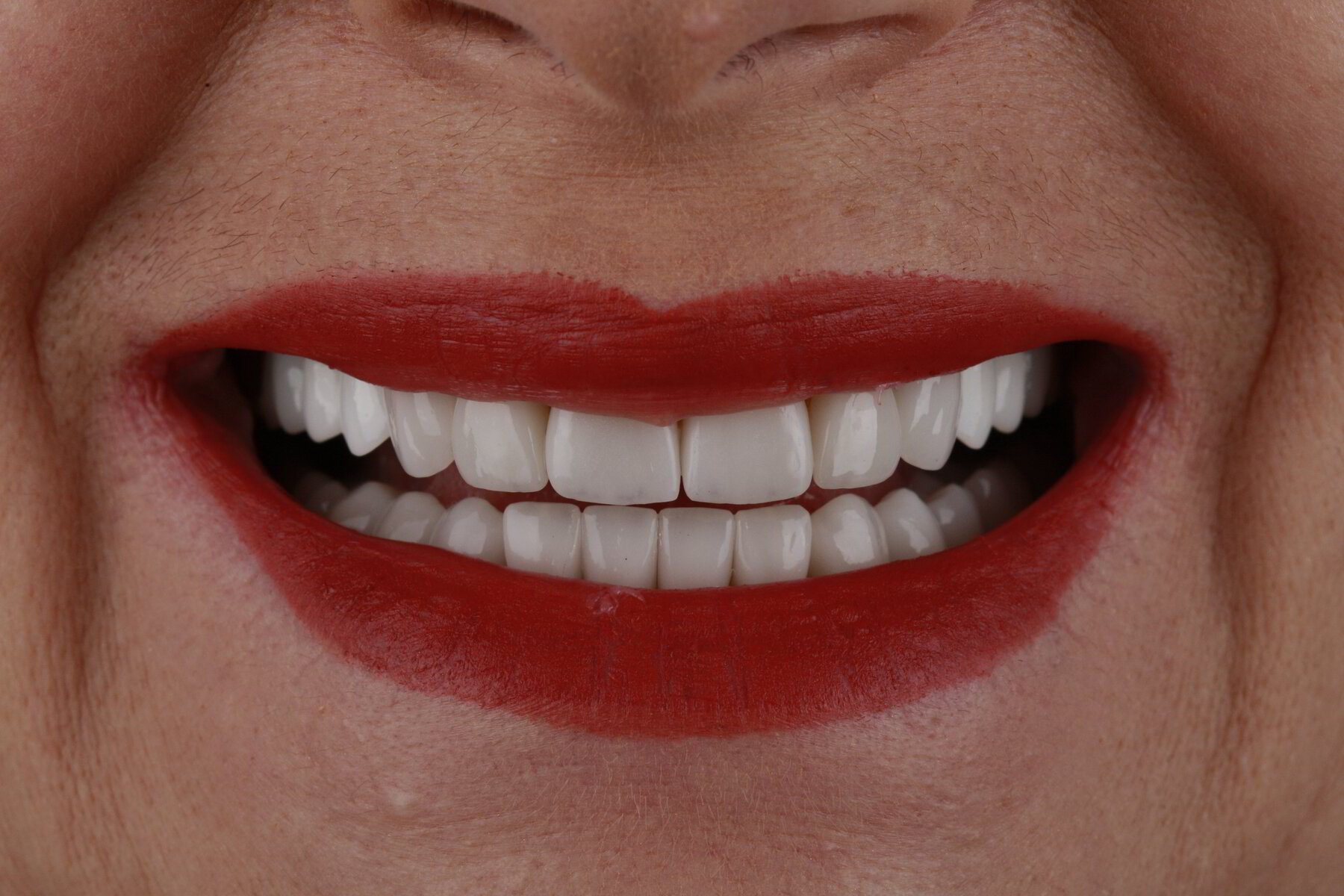 Dinti ficsi in doar 24 de ore - Fast&Fixed