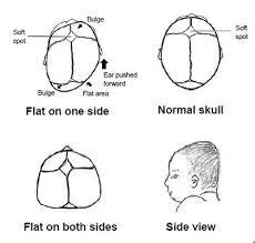 Plagiocephaly