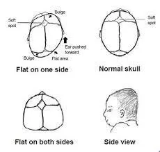 Plagiocephaly