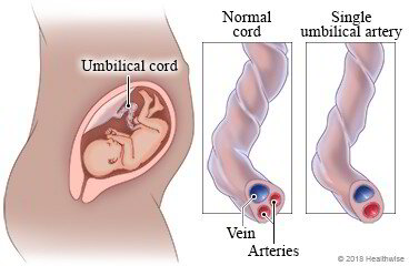 Two Vessel Umbilical Cord, What Does That Mean?