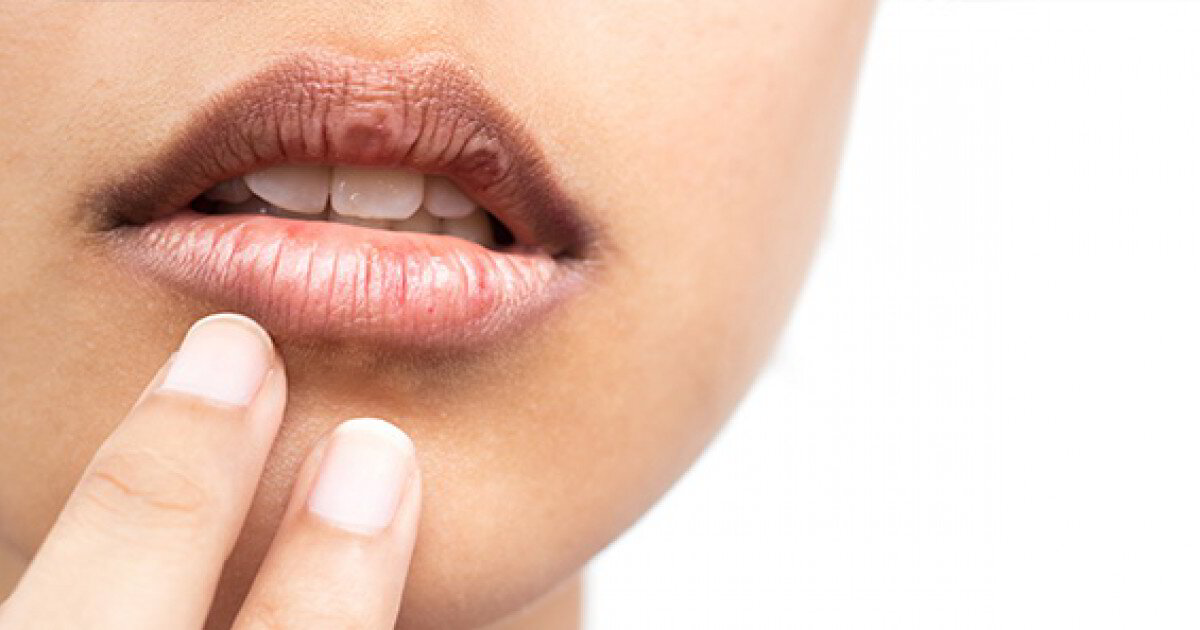 Best Lip Pigmentation treatment clinic at Hyderabad | Évoluer Aesthetics