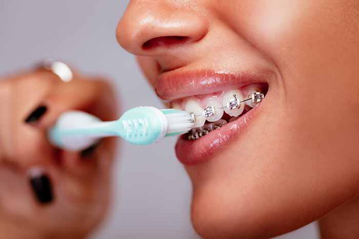 How To Take Care Of And Maintain Your Braces