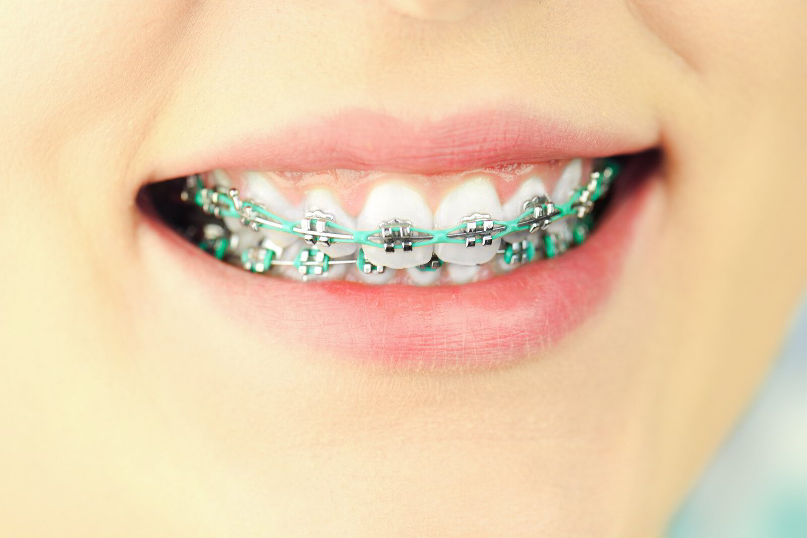 The Surprising Benefits Of Getting Braces As An Adult?