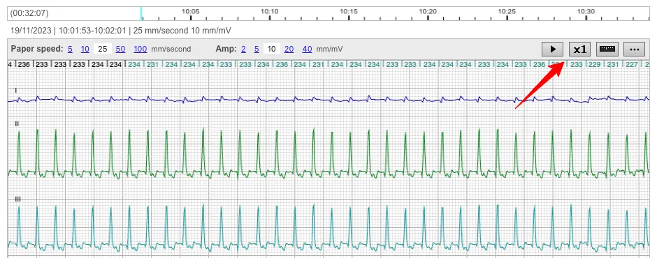 Beecardia ECG viewer - moving the waves