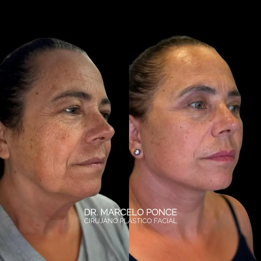 Lifting Facial Deep Plane en Guayaquil