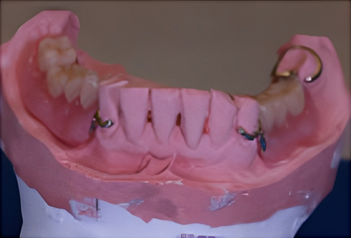 Gold Castings | Hizart Dental Laboratory