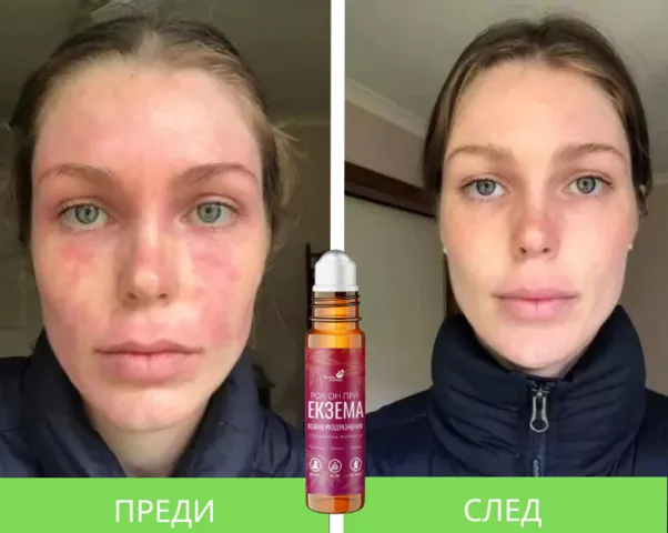 Рол Он при екзема и кожни раздразнения