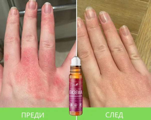 Рол Он при екзема и кожни раздразнения