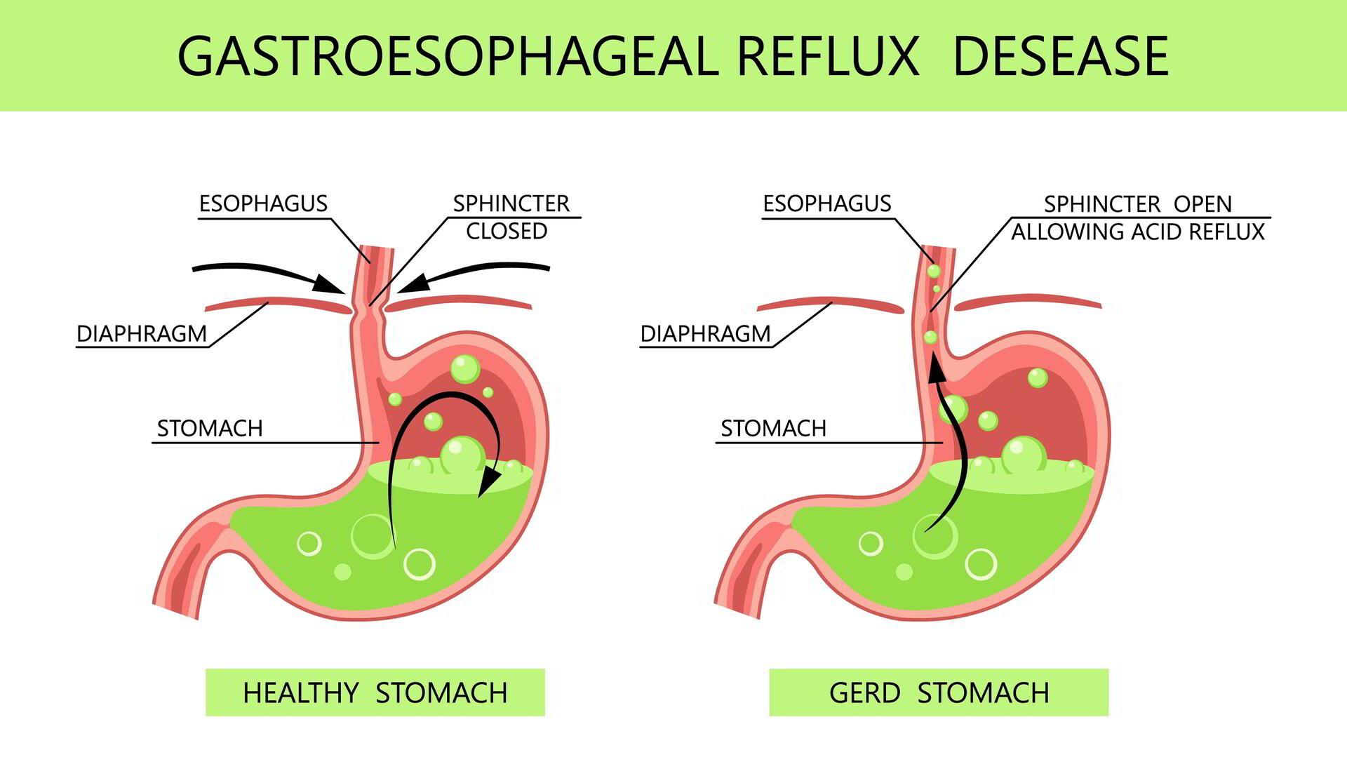 Which foods can cause acid reflux (GERD)?