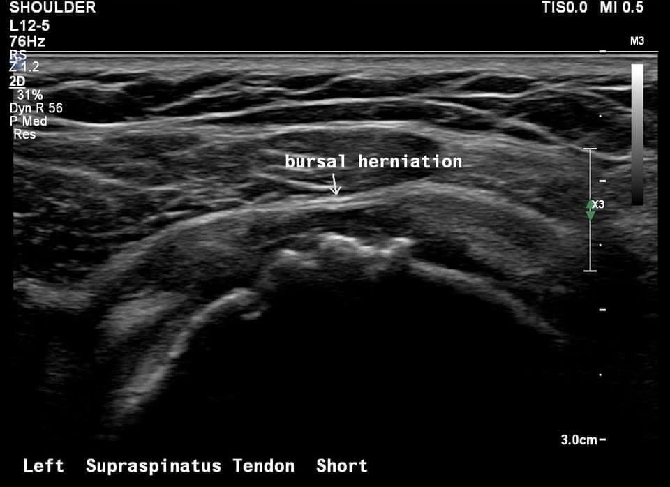 Rotator Cuff Tear