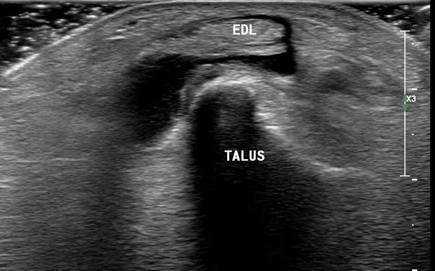 Gruberi Bursitis