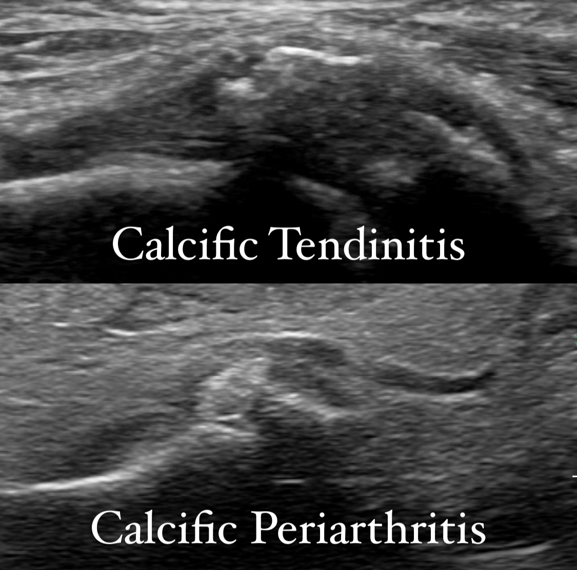 Calcific Tendinitis vs. Calcific Periarthritis